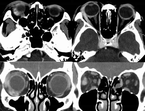 Orbital Pseudotumor