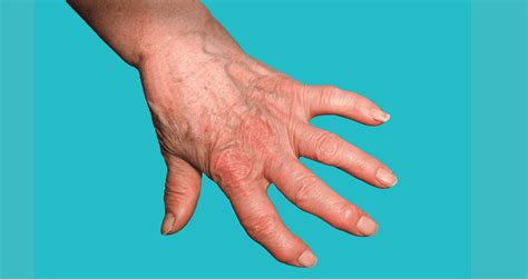 Eular 2024 Establecen Vínculo Entre La Menopausia Y La Exacerbación