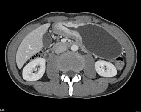 Gastric Adenocarcinoma Gastric Adenocarcinoma Case Study Stomach
