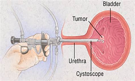 Dr Tim Nathan Urology Bladder Tumours