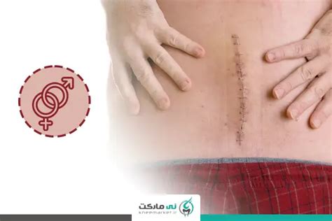 تاثیر جراحی دیسک کمر بر رابطه جنسی چیست؟ معرفی پوزیشن های جنسی مناسب