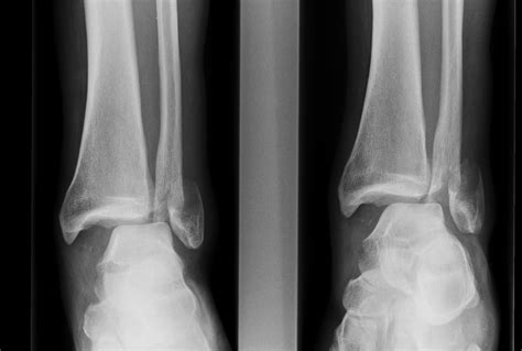 Ankle Fracture Dislocation In The South Pacific R Brokenbones