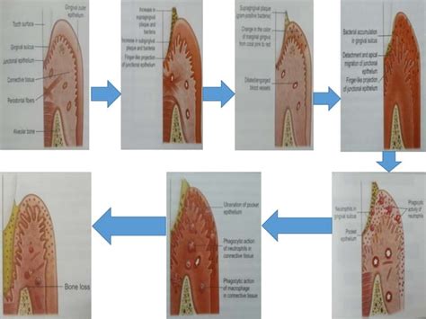 Gingival Inflammation Ppt