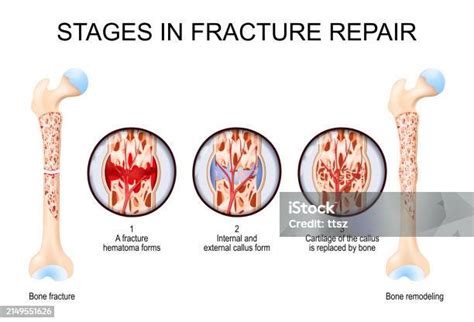 Stages In Fracture Repair From Bone Fracture To Bone Remodeling Stock