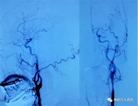 山西省心血管病医院脑血管病中心颈动脉慢性闭塞再通个案报道 脑医汇