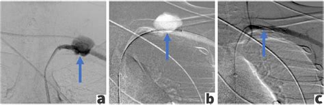 Selective Catheterization Of Left Subclavian Artery Using H1 Catheter