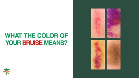 Different Types Of Bruises Maryam Memorial Hospital Youtube
