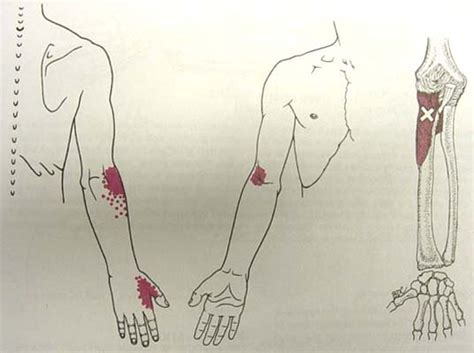 회외근 Supinator 의 근막통증군 네이버 블로그