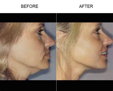 Thermacool Florida Florida Thermage Non Surgical Face Lift Orlando