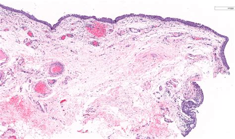 Eye Conjunctiva Nus Pathweb Nus Pathweb
