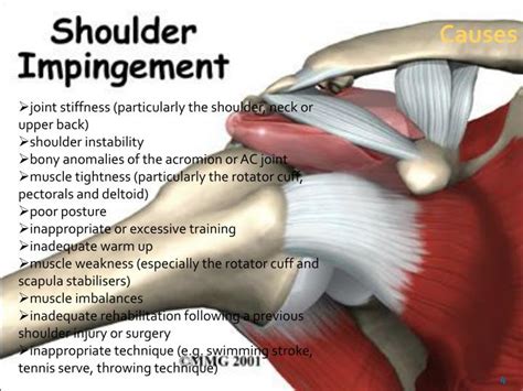 Ppt Shoulder Impingement Syndrome Powerpoint Presentation Id 2381718