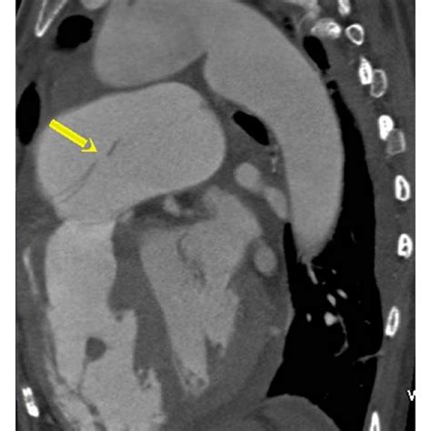 Intimal Flap Features Determined On Ct Angiography Transverse Sections