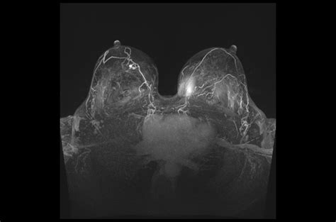 Plan Breast Dynamic Mip Mrimaster