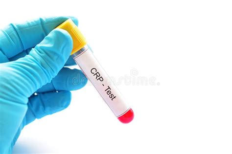 C Reactive Protein Test Stock Photo Image Of Analysis 121827592