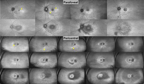 Frontiers Novel Imaging Techniques For Hydroxychloroquine Retinopathy