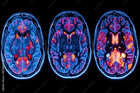 Brain Scan A Detailed Image Of An Mri Brain Scan Showing Different Regions And Potential