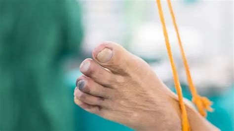 Cli Critical Limb Ischemia Treatment