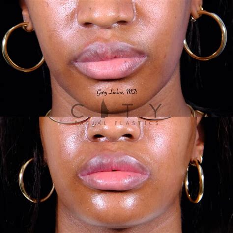 Lip Reduction In Manhattan New York
