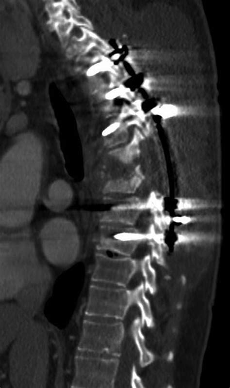 Postoperative Sagittal Ct Scan Of The Thoracic Spine Demonstrating Download Scientific Diagram