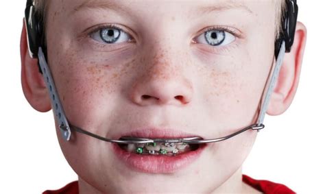 강남 청담 초등학생 및 어린이 치아교정혼합치열기 진단이 중요합니다 교정전문의 칼럼 에스플란트치과병원 교정과