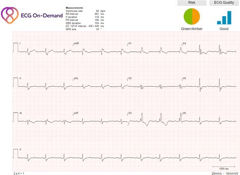 Sinus Rhythm With Right Bundle Branch Block Ambulatory Ecg Holter Monitoring Ecg On Demand