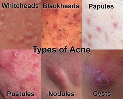 Acne Papules Treatment