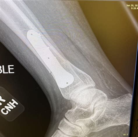 4 Weeks Healed Tibial Derotational Osteotomy On An Adult Bonus Pic Of