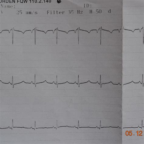 Electrocardiography With Prolonged QT Interval Msn Download Scientific Diagram