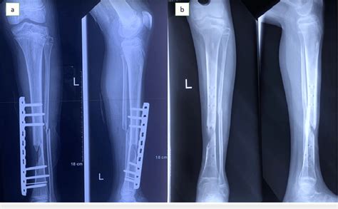 Radiological Images Following Surgery Showing Bone Alignment Using An Download Scientific