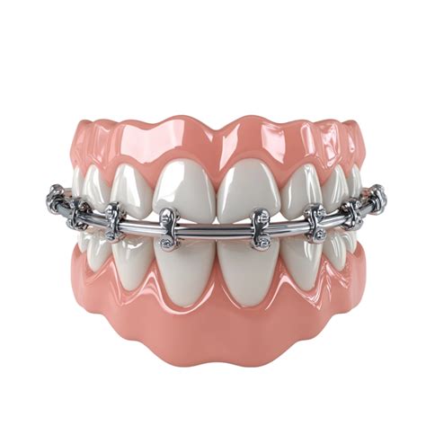 Dental Braces On Teeth Model 55544173 Png