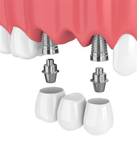Dental Implant Treatment In Luton Wayside Dental Practice