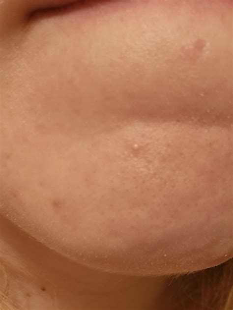 Accutane Vs Amnesteem Racne