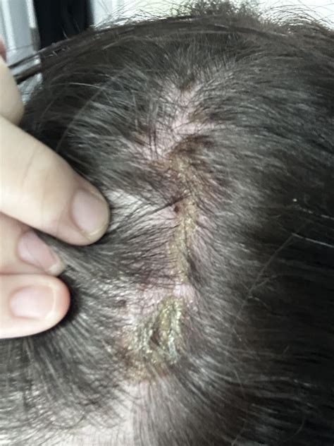 Picking Scalp Causing Scabs Need Help Rcalmhands Picking Scalp Causing Scabs Need Help Rcalmhands