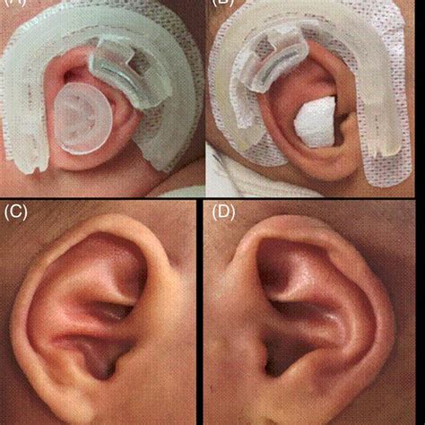 Upper Row Conchal Correction A Correct Conchal Crus With The