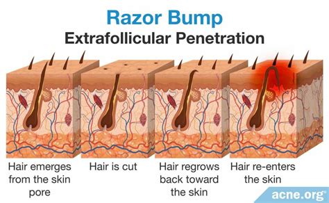 What Are Razor Bumps