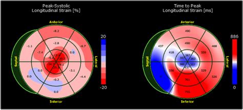 Classic Example Of Reduced Global Longitudinal Strain With Apical Download Scientific Diagram