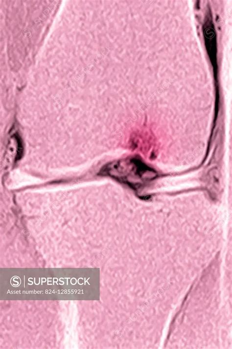 Osseous Edema On The Knee Sub Cortical Lesion Of The Condyle Seen On A Frontal Section MRI