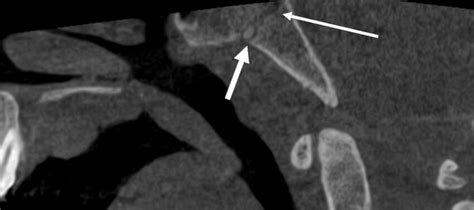 Sagittal View Arrows Opened Sphenooccipital Synchondrosis Thin