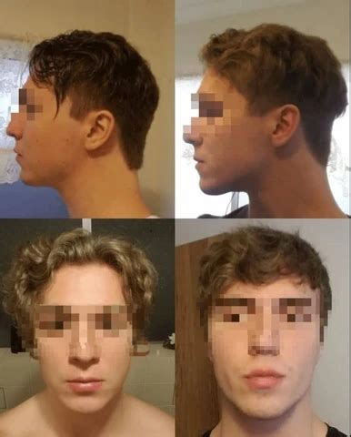 Mewing Before And After With Dr Mew Mewing App