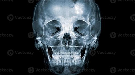 Normal Frontal Skull Xray