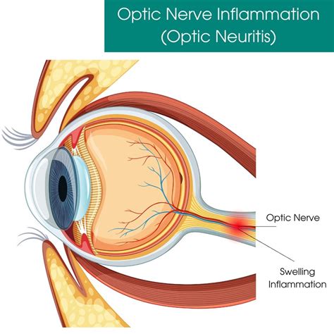 Optic Nerve Hypoplasia Treatment Nyc Optic Neuritis Specialist In