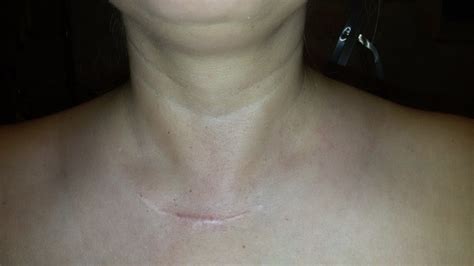 Лимфоузлы на плече расположение у женщин фото