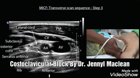 Costoclavicular Block Youtube