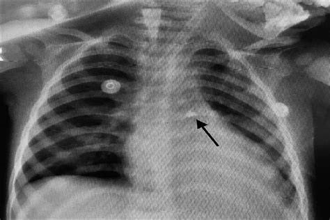 The Chest X Ray Of The Patient Revealing Radiopaque Foreign Body In