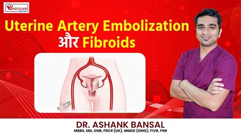 Uterine Artery Embolization For Fibroids By Dr Ashank Bansal Youtube