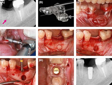 Advances In Surgical Template Design In Dental Implantology Journal