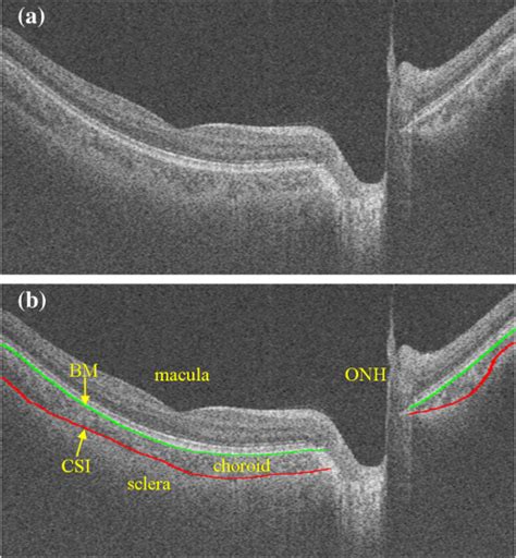 Automated Choroid Segmentation In Three Dimensional 1 μm Wide View Oct Images With Gradient And
