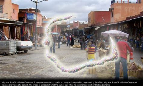 Ocular Migraine Optic Migraine Retinal Migraine Visual Migraine