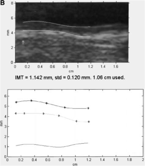 a imt measure of the distal common carotid of an unaffected male