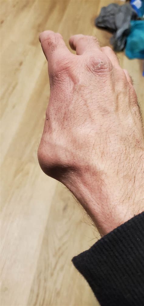 Dislocated My Thumb R Wellthatsucks